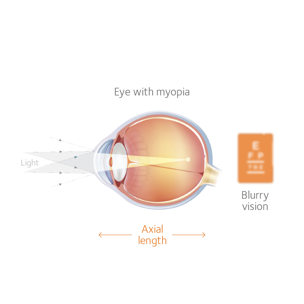 Myopia Management | Utah Valley Eye Center